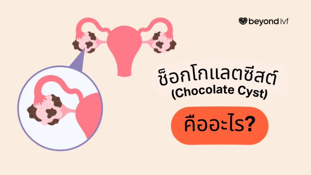 BeyondIVF • What Are the Symptoms of Chocolate Cysts? Can They Go Away ...