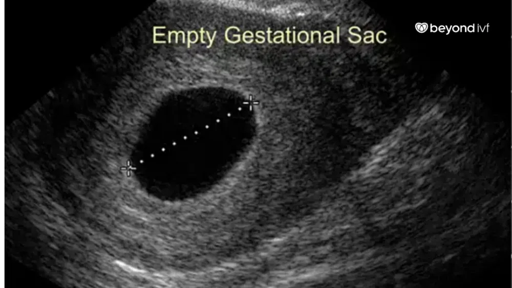 BeyondIVF • What is Blighted Ovum? Is it dangerous? Causes, Symptoms ...